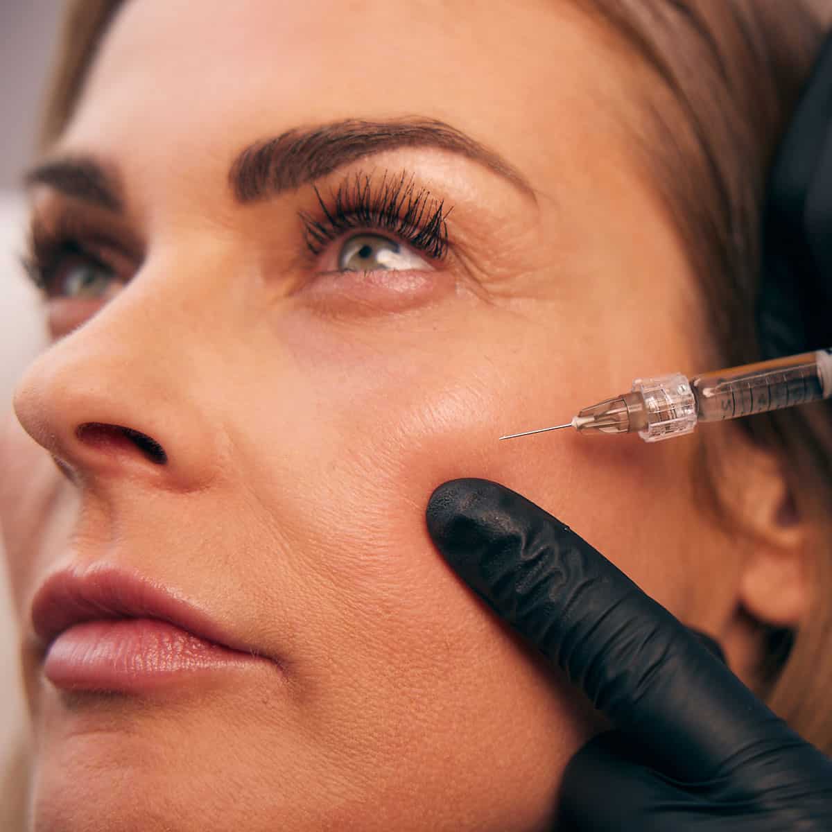 Filler behandling af rynker | Book tid i dag > Priser fra 1.800,-